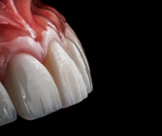 Explore iMAX for Natural Looking Crowns & Veneers