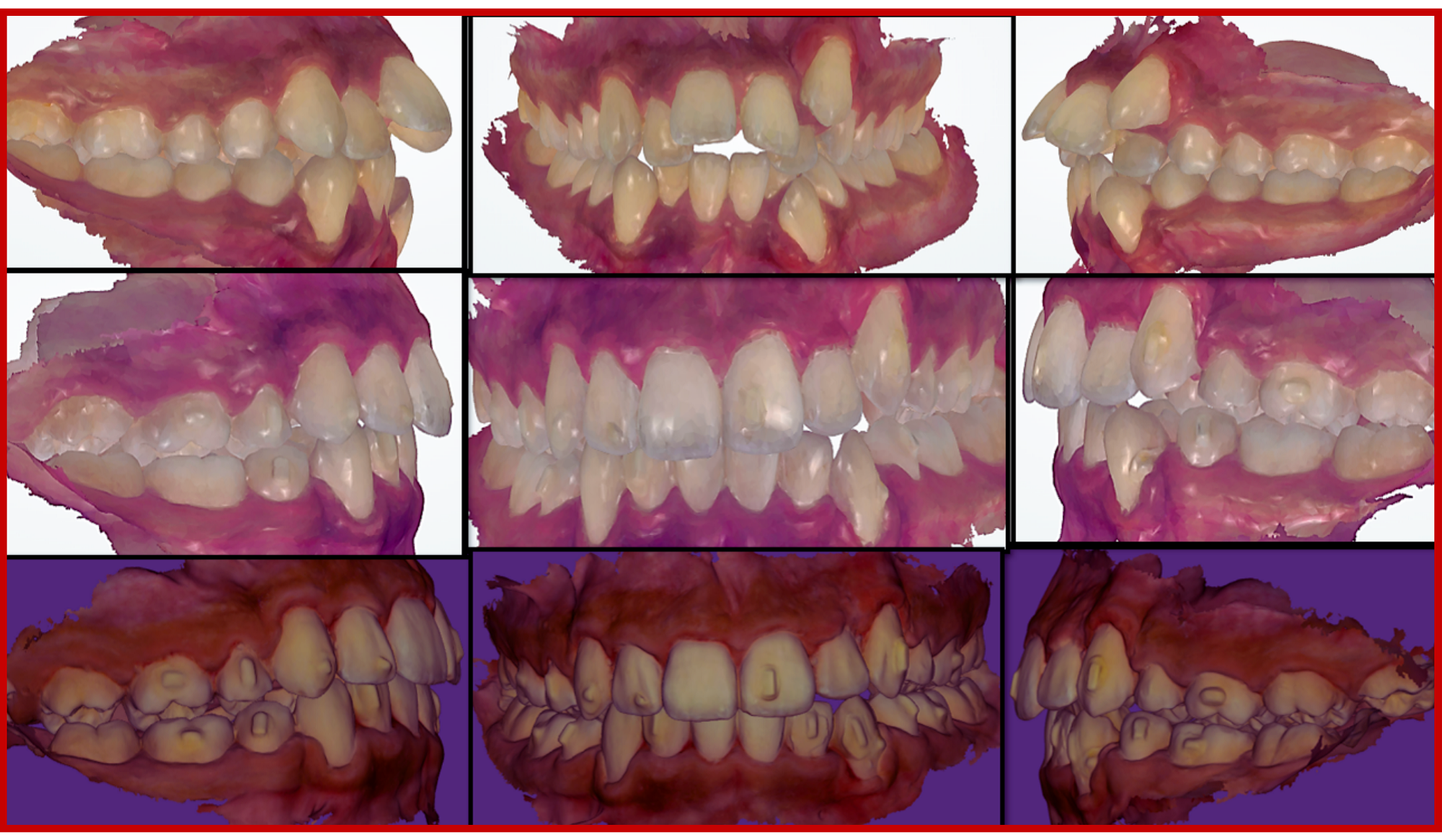 Clear Aligners – Reliable Orthodontic Solution for Straighter Teeth