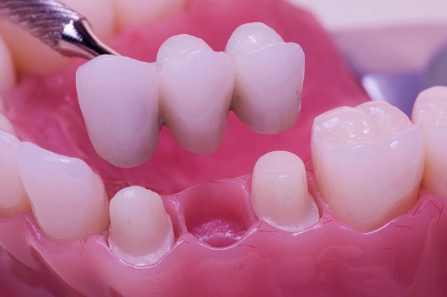 Illusion Dental Lab | Dental Products and Services