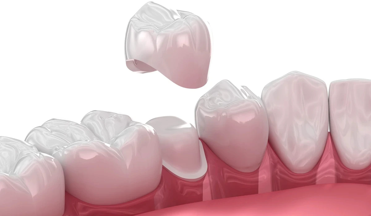 Common Queries About Dental Crowns Explained: Types, Costs & Care