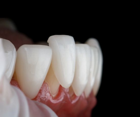 Choose iMAX Crown for Premium Lithium Disilicate Restoration